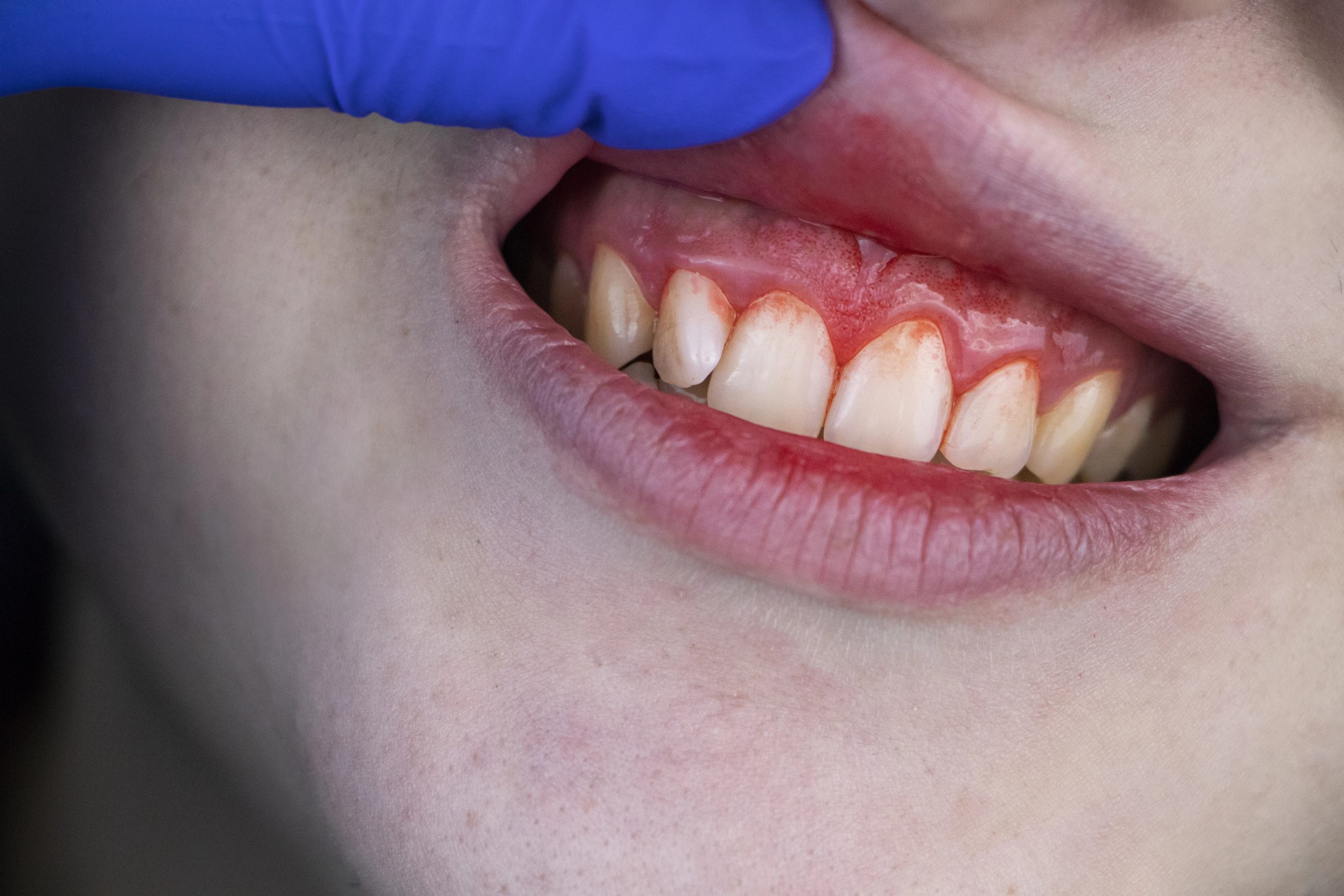 Gums After Tooth Extraction: Healing Stages